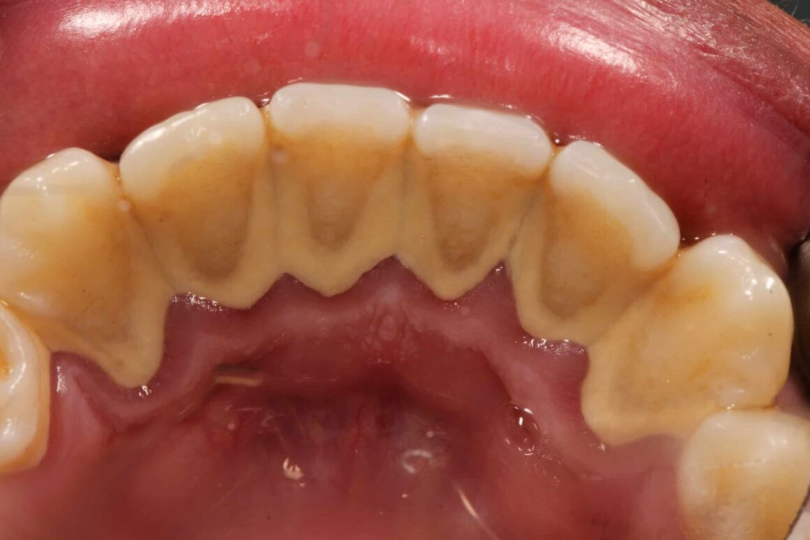 Dental tartar: Hardened deposit that forms on teeth when dental plaque ...