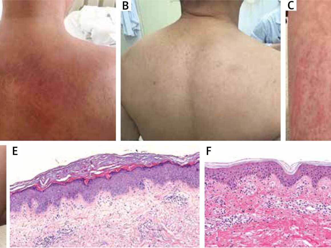 Adult Still’s Disease: Unraveling the Complexities of a Rare Systemic ...